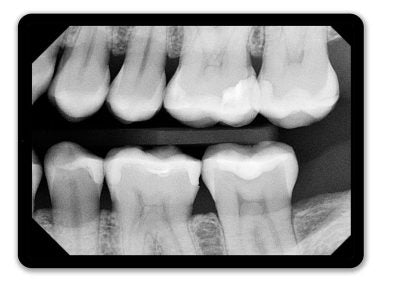 XDR Clarity™ Size 2 Sensor – Archer Dental