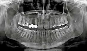 MyRay Hyperion X5 CBCT – Archer Dental