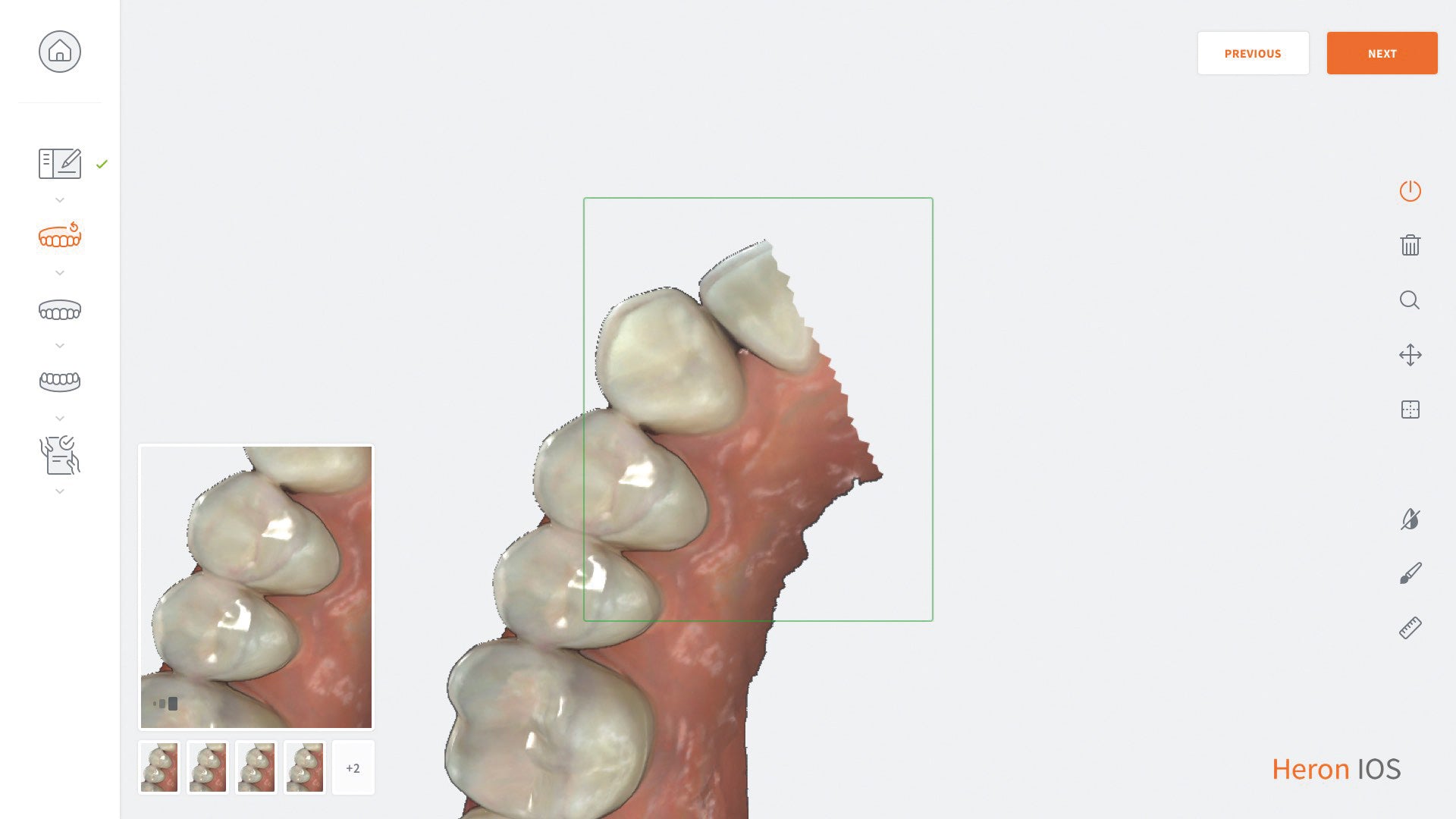 3DISC Heron™ IOS Intraoral Color Impression Scanner with Laptop and So ...
